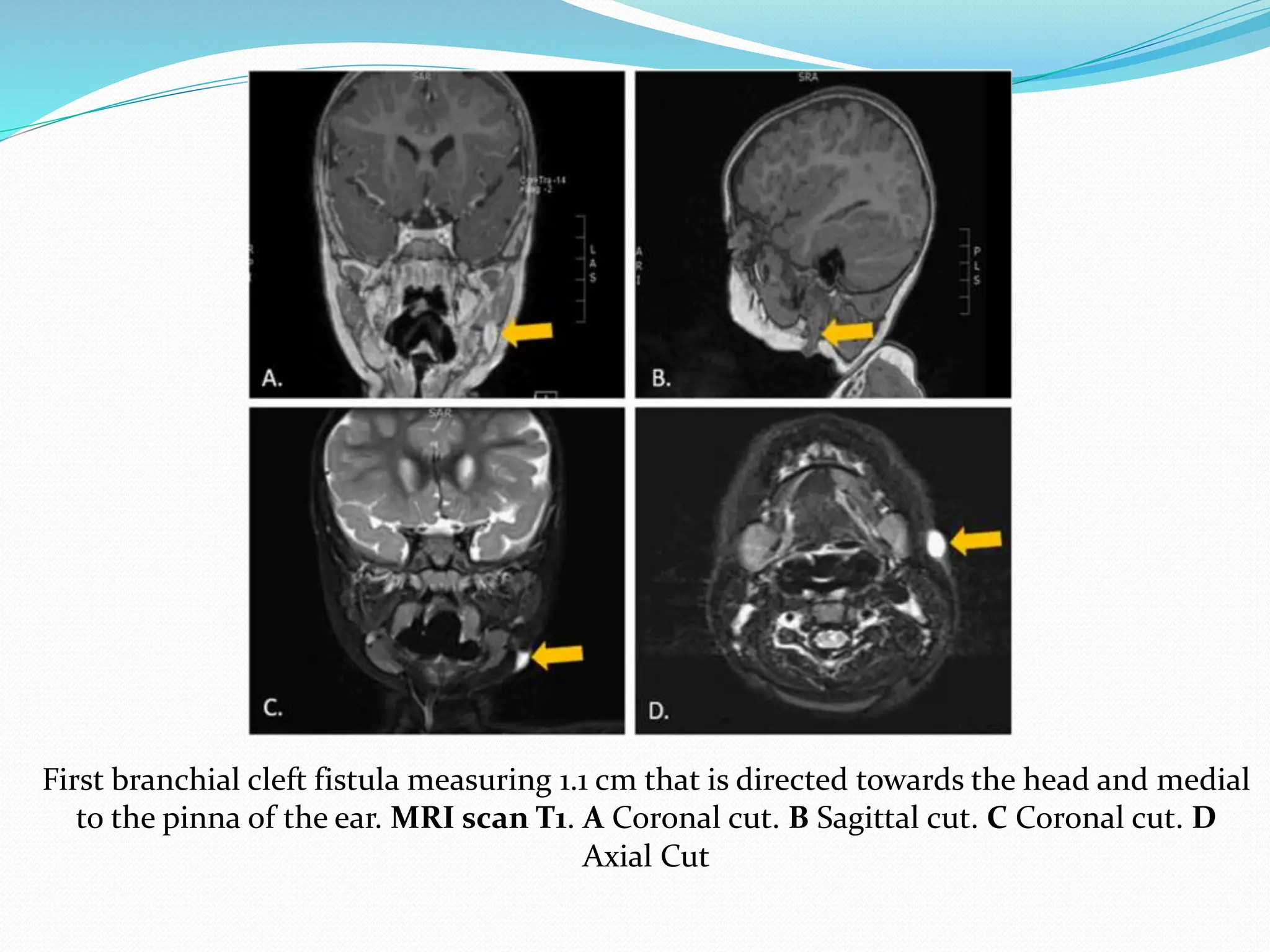 Congenital Sinuses of The Neck and its Etiology | PPTX