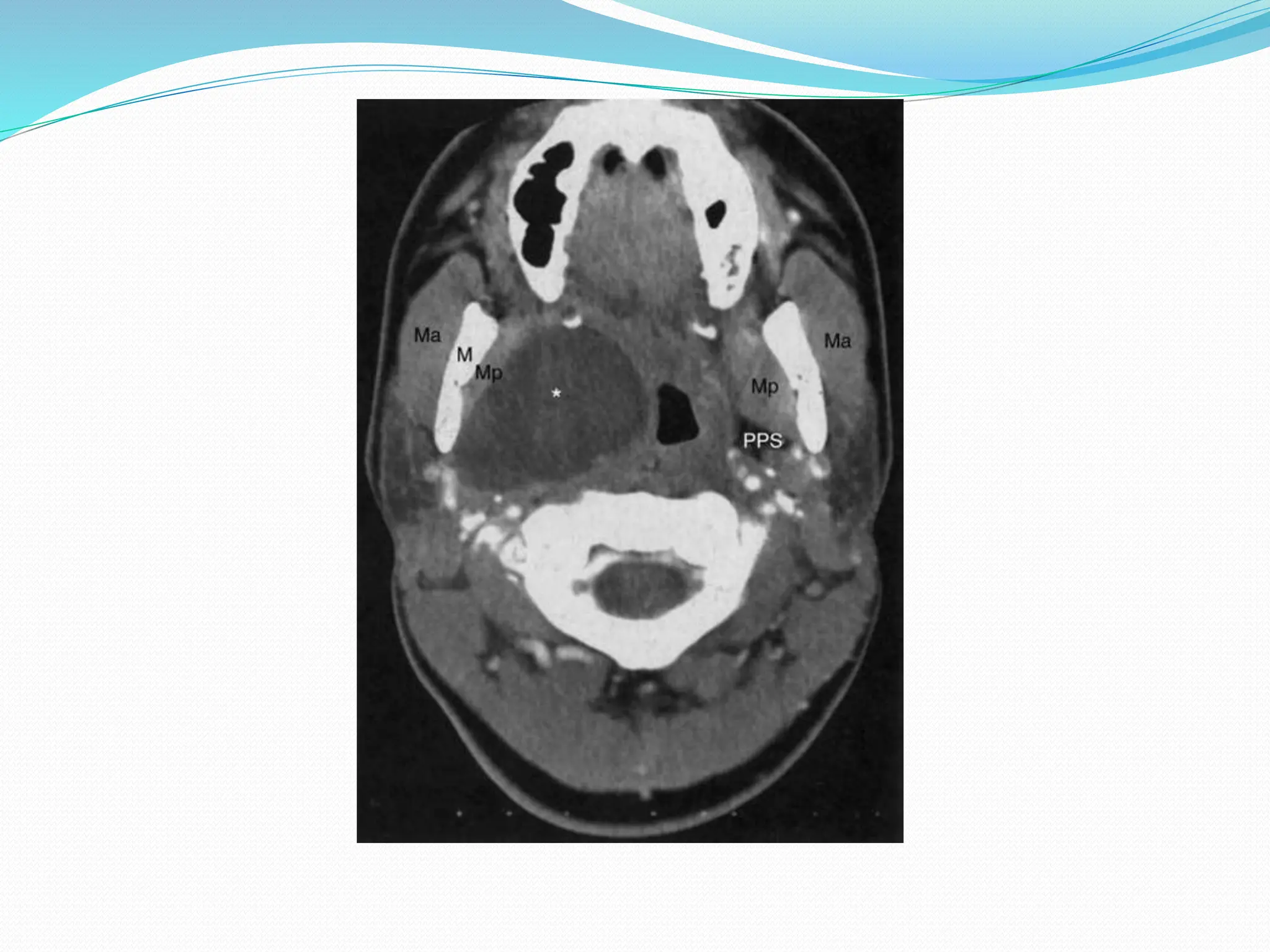 Congenital Sinuses of The Neck and its Etiology | PPTX