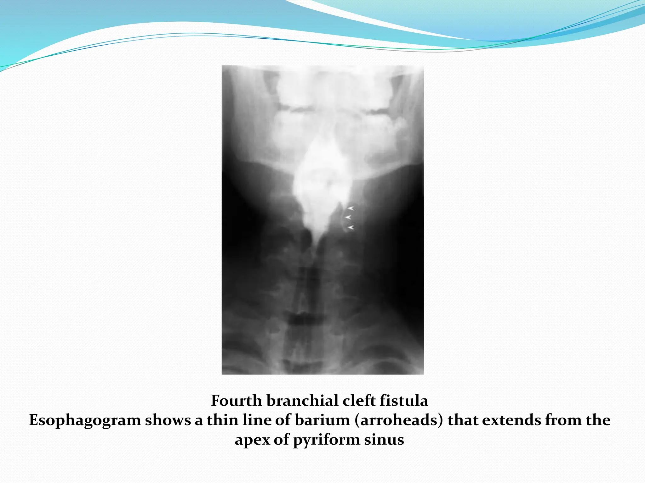 Congenital Sinuses of The Neck and its Etiology | PPTX