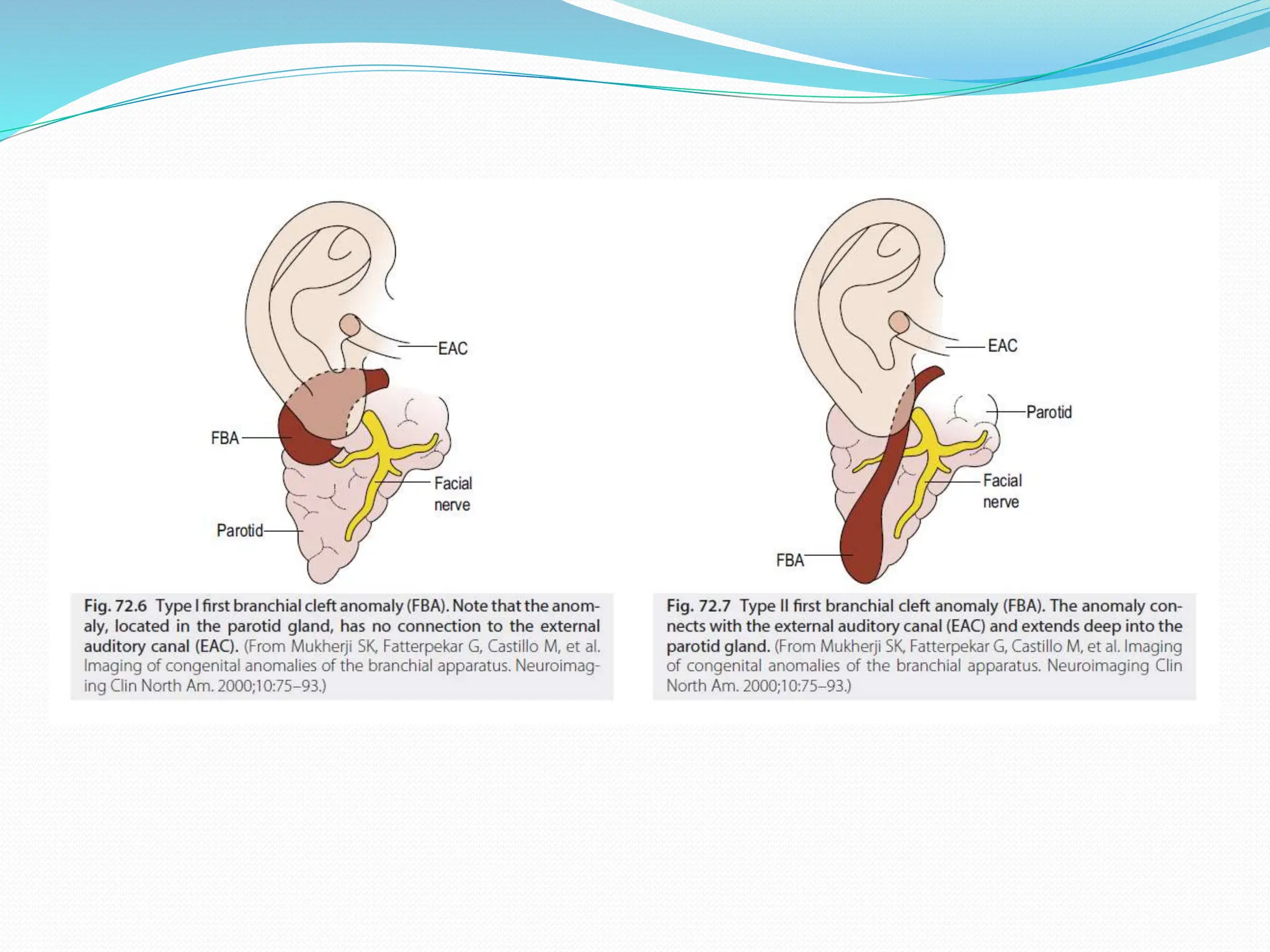 Congenital Sinuses of The Neck and its Etiology | PPTX