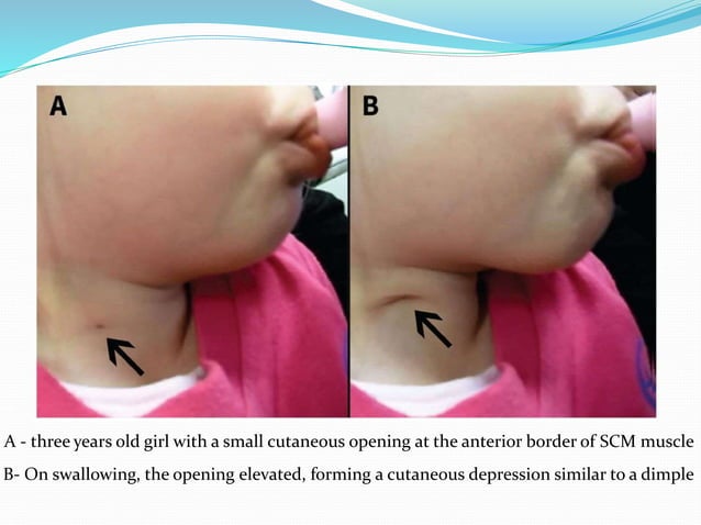 Congenital Sinuses of The Neck and its Etiology | PPTX | Ear, Nose and ...