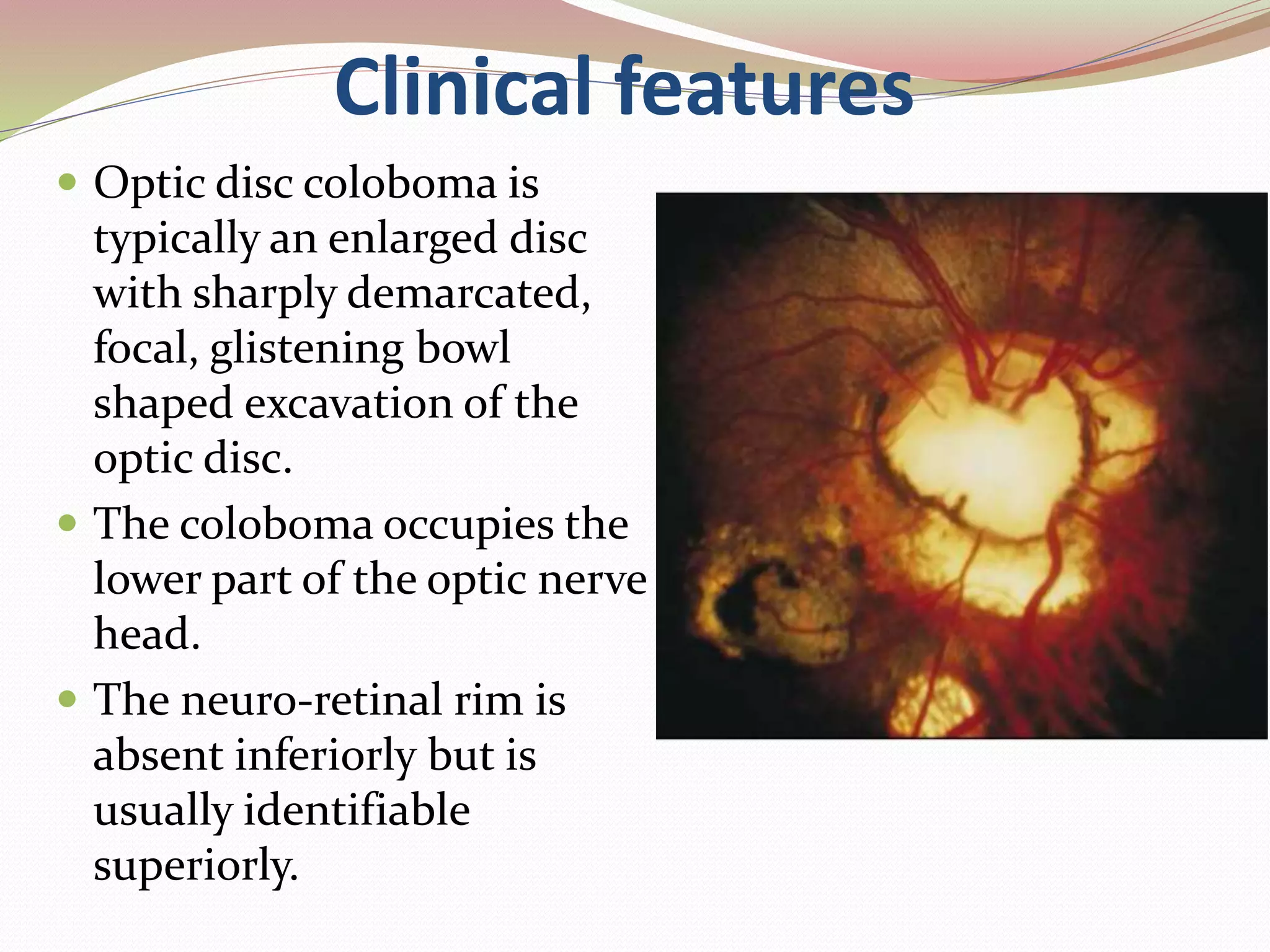 Congenital optic disc anomalies | PPTX