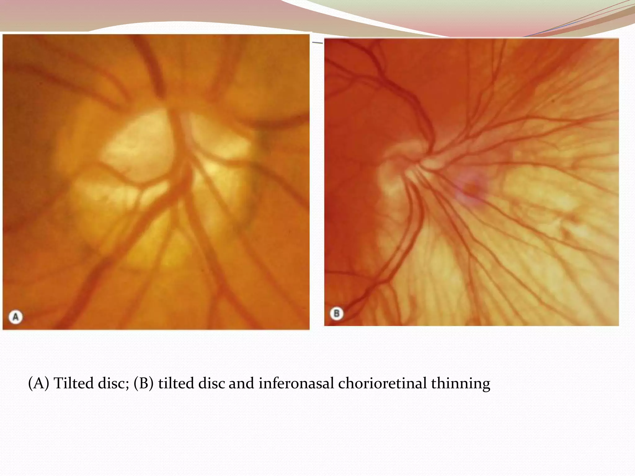 Congenital optic disc anomalies | PPTX