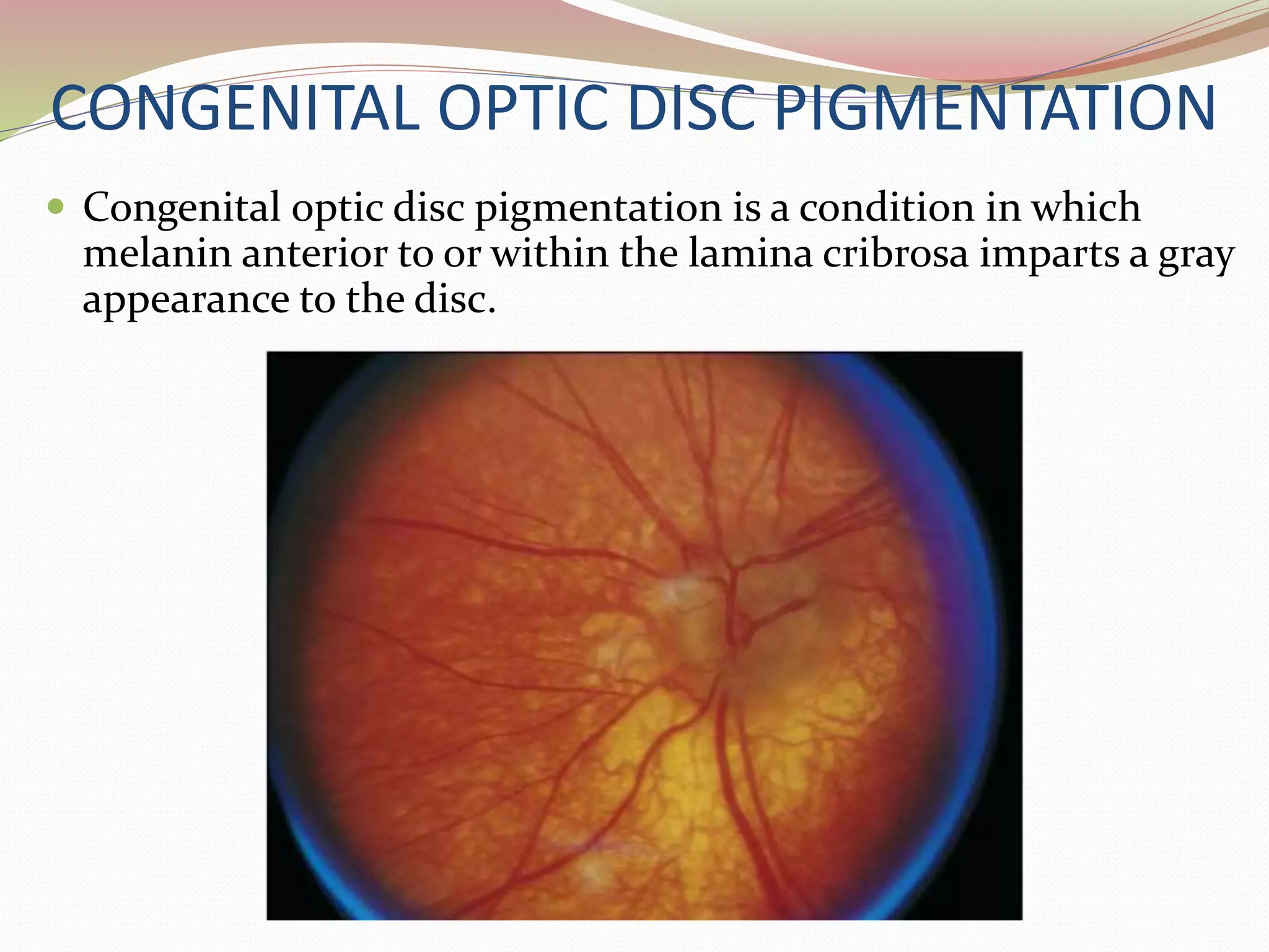 Congenital optic disc anomalies | PPTX