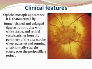 Congenital optic disc anomalies | PPTX