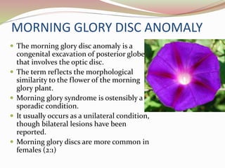Morning Glory Syndrome Optic Nerve