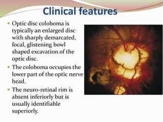 Congenital optic disc anomalies | PPT