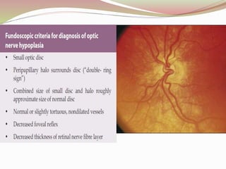 Optic Nerve Hypoplasia