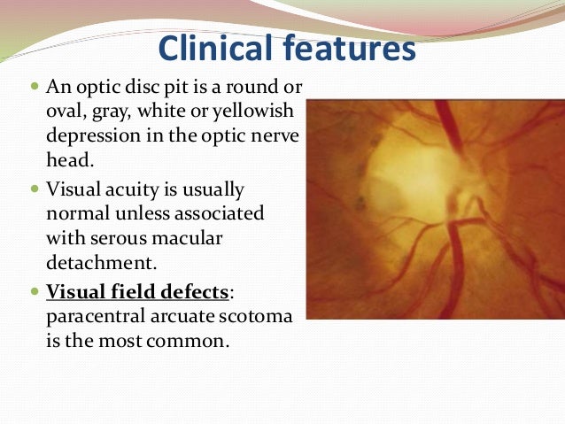 Congenital optic disc anomalies