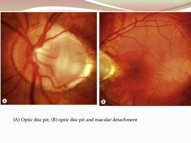 Congenital optic disc anomalies