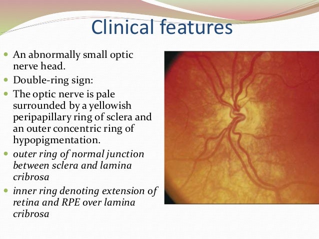 Congenital Optic Disc Anomalies
