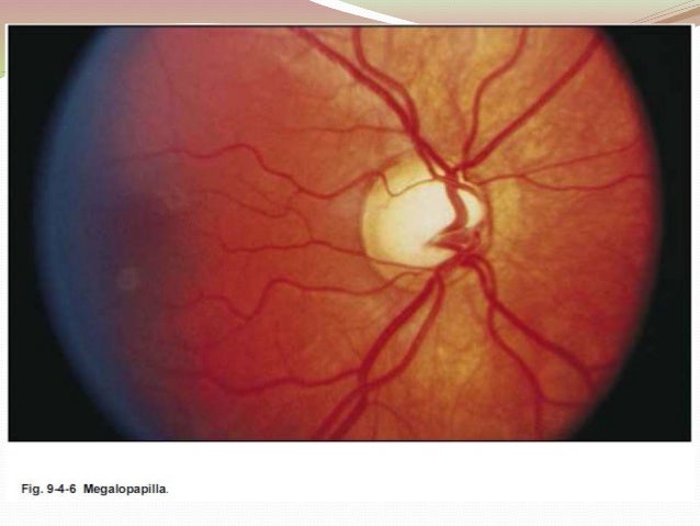 Congenital optic disc anomalies