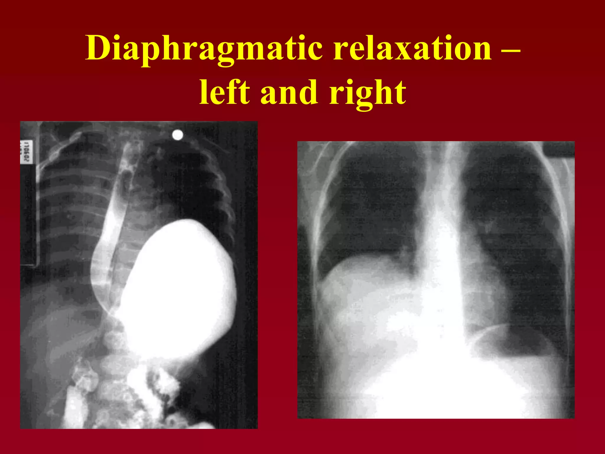 Congenital pathology of the diaphragm.ppt