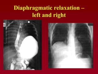 Congenital pathology of the diaphragm.ppt