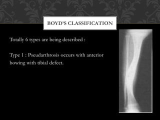 Congenital pseudarthrosis | PPTX