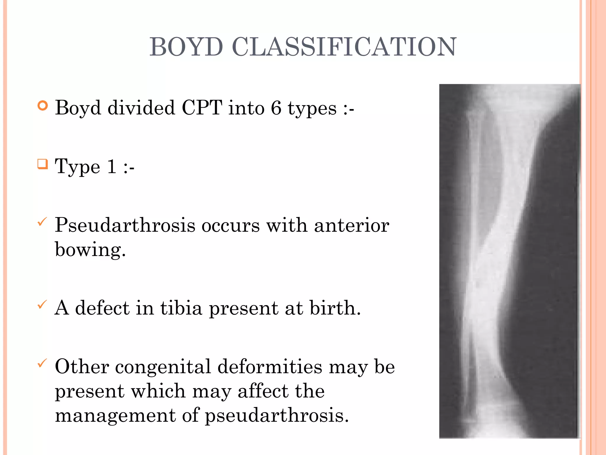 Congenital pseudarthrosis of tibia | PPT