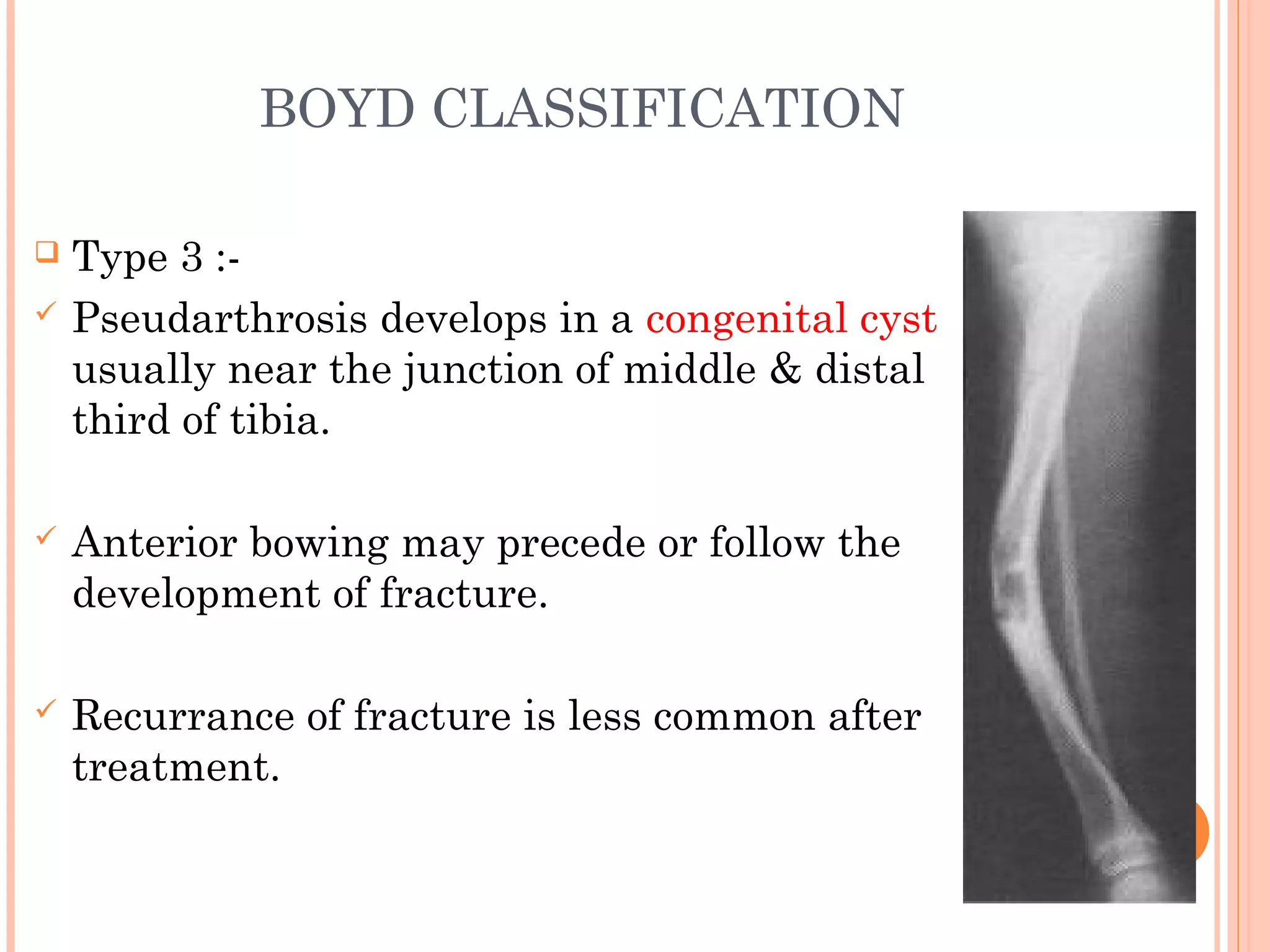 Congenital pseudarthrosis of tibia | PPT