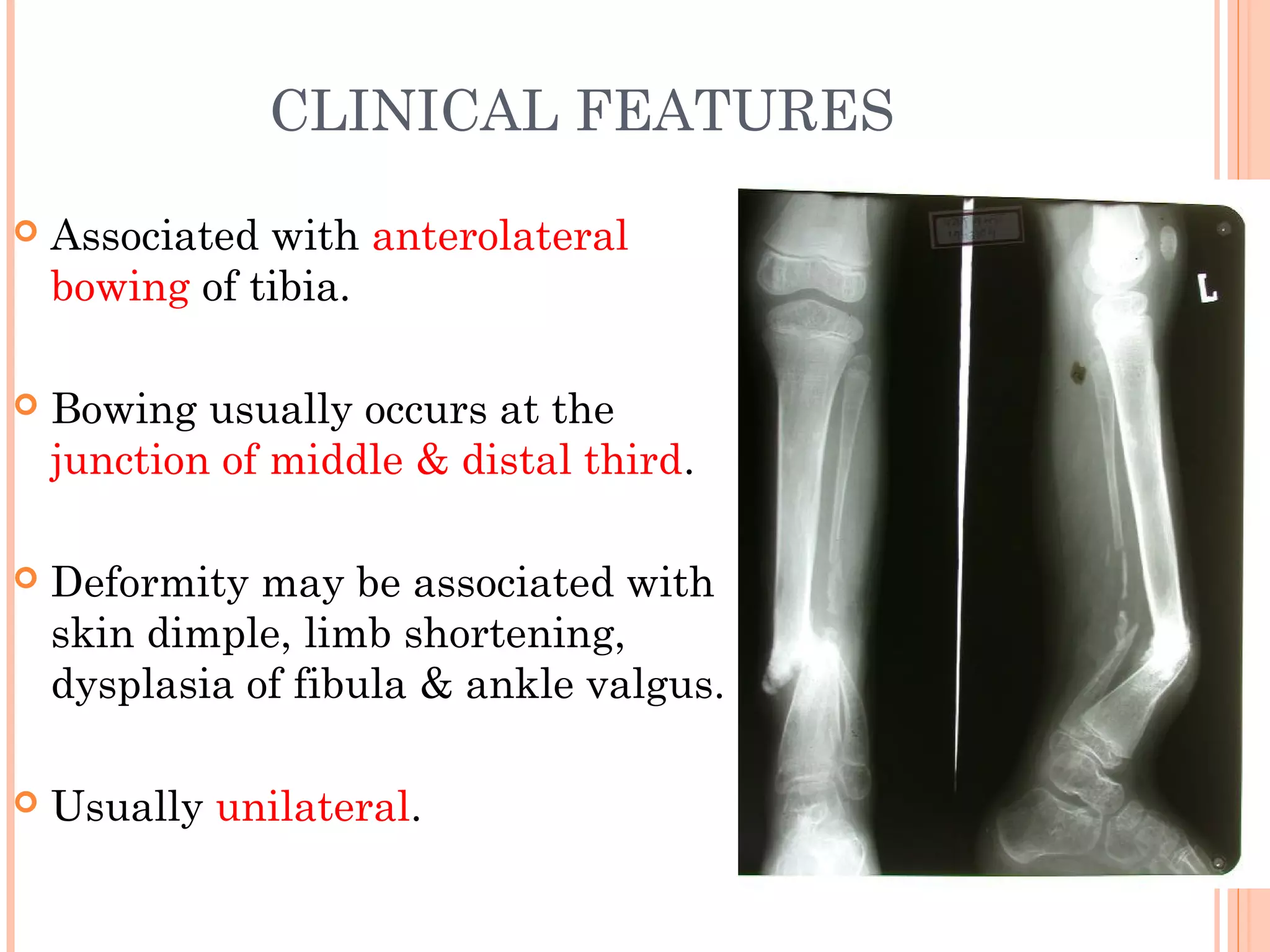 Congenital pseudarthrosis of tibia | PPT