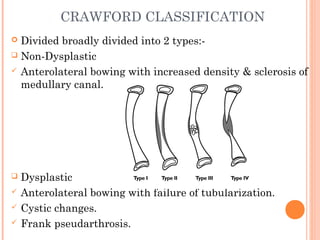 Congenital pseudarthrosis of tibia | PPT