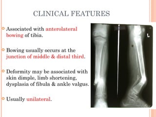 Congenital pseudarthrosis of tibia | PPT