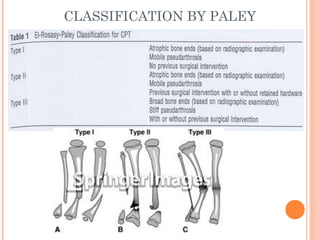 Pseudoartrose Tibial Pseudarthrose Der Tibia: Versuch Der Heilung