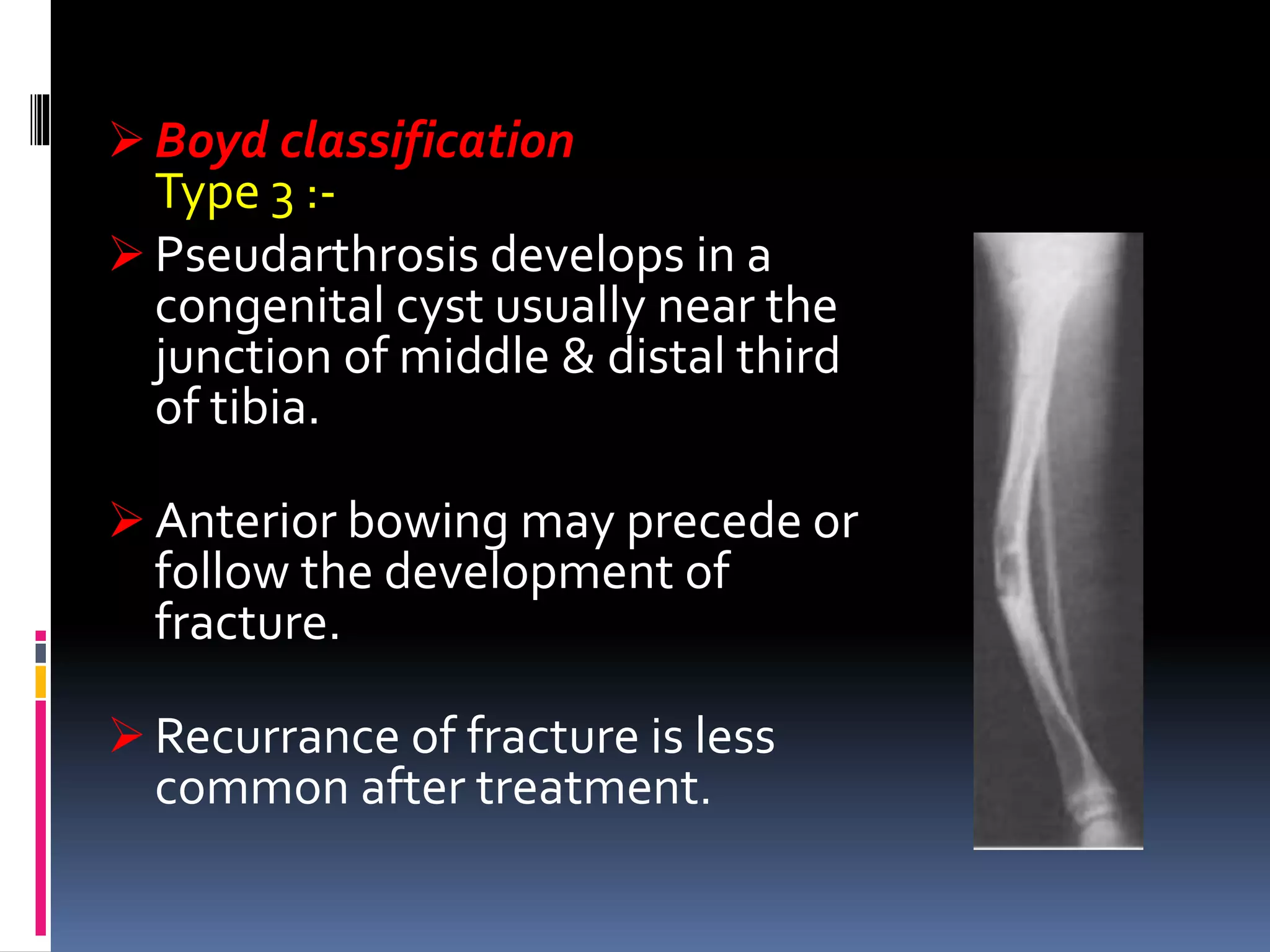 Congenital pseudarthrosis of tibia (CVT) | PPTX | Death, Injury, or ...