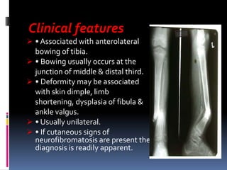 Congenital pseudarthrosis of tibia (CVT) | PPTX | Death, Injury, or ...