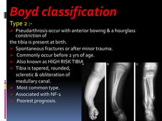 Congenital pseudarthrosis of tibia (CVT) | PPTX | Death, Injury, or ...