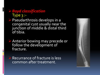 Congenital pseudarthrosis of tibia (CVT) | PPTX | Death, Injury, or ...