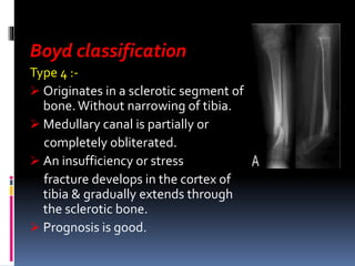 Congenital pseudarthrosis of tibia (CVT) | PPTX | Death, Injury, or ...