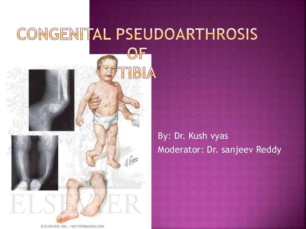 Congenital pseudoarthrosis