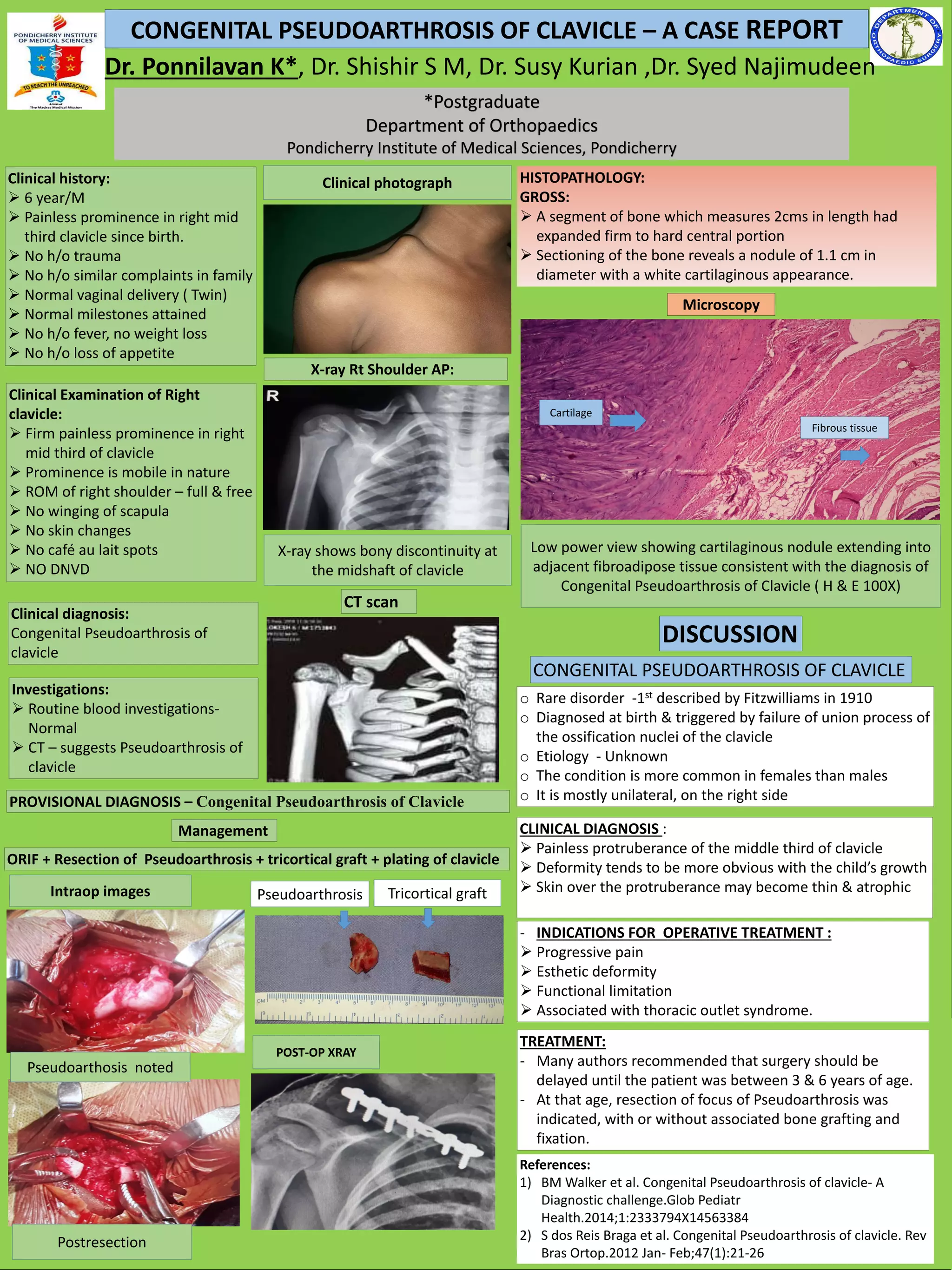 Congenital pseudoarthrosis of clavicle | PPTX