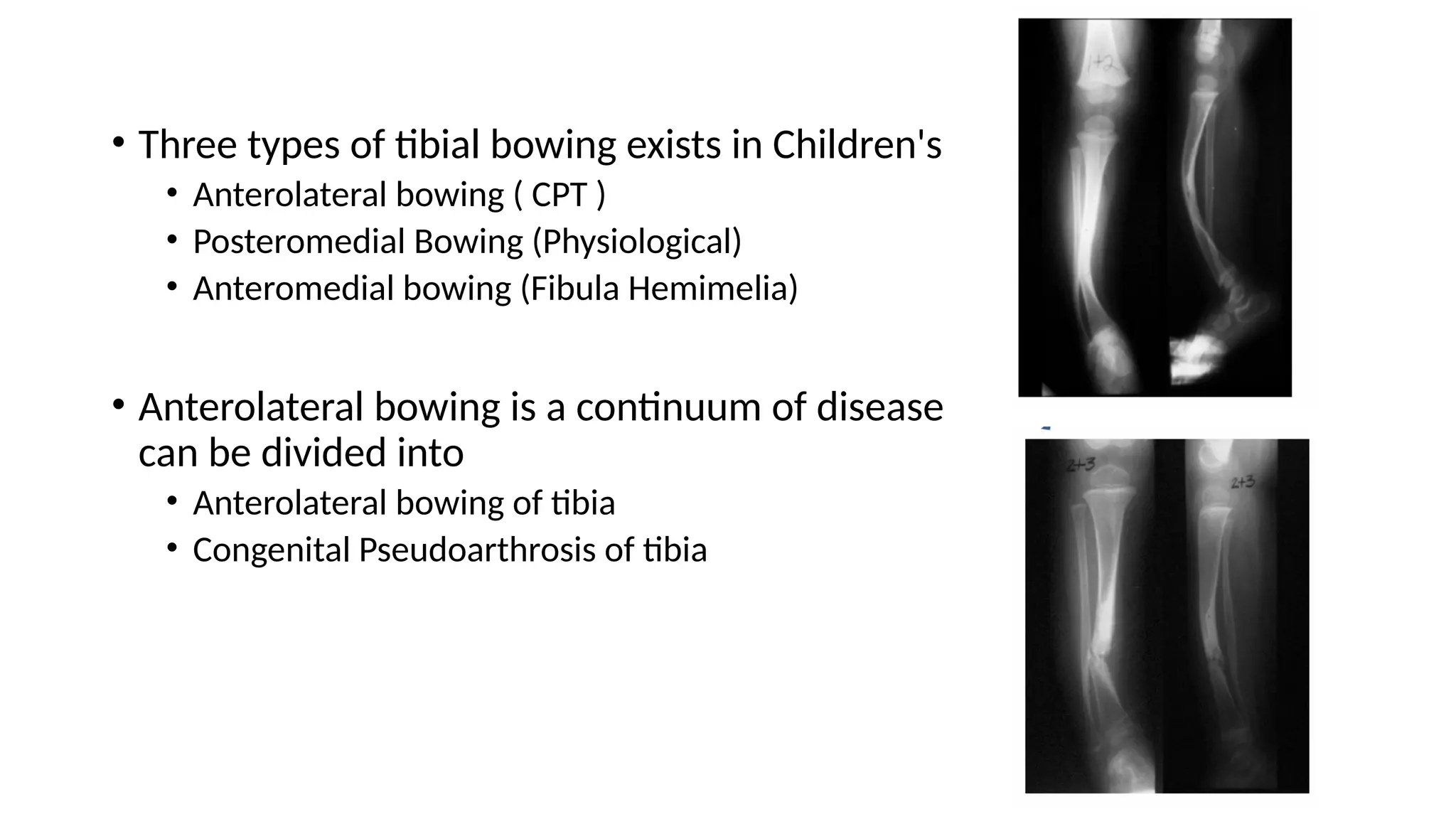 CONGENITAL PSEUDO ARTHROSIS OF TIBIA-1.pptx