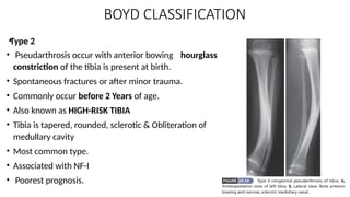 CONGENITAL PSEUDO ARTHROSIS OF TIBIA-1.pptx