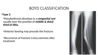 CONGENITAL PSEUDO ARTHROSIS OF TIBIA-1.pptx