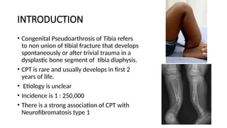 CONGENITAL PSEUDO ARTHROSIS OF TIBIA-1.pptx