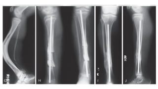 CONGENITAL PSEUDO ARTHROSIS OF TIBIA-1.pptx