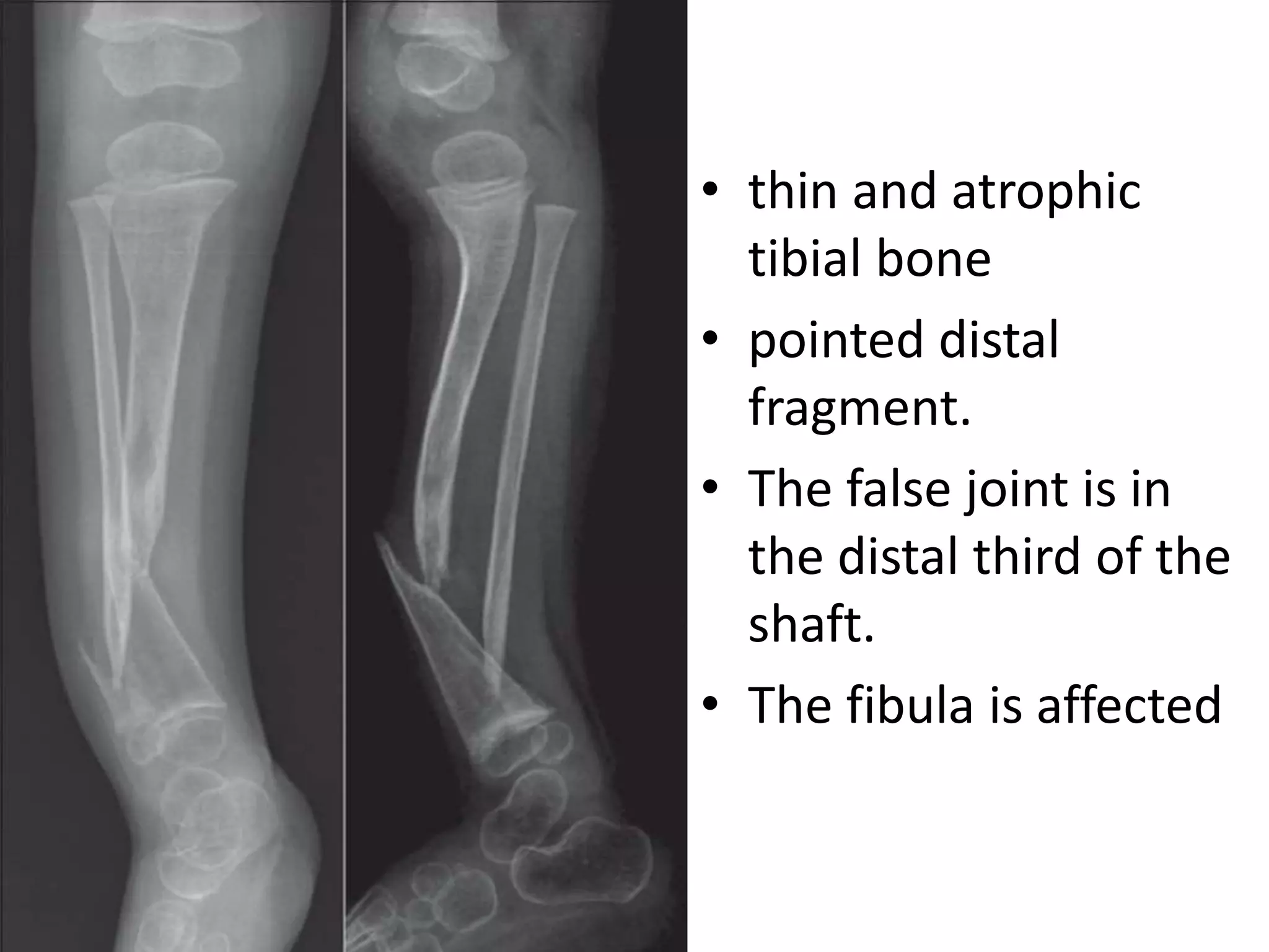 Congenital pseudo arthrosis of tibia | PPTX