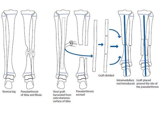 Congenital pseudo arthrosis of tibia