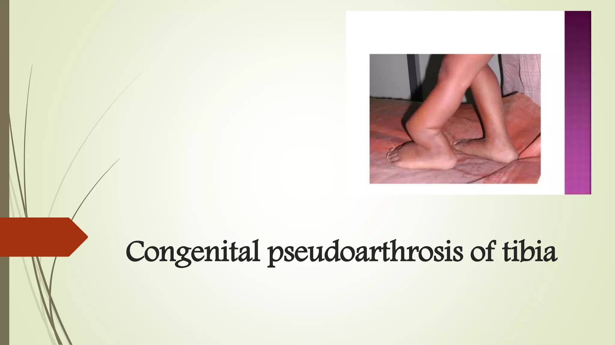 Congenital pseudoarthrosis of tibia | PPTX
