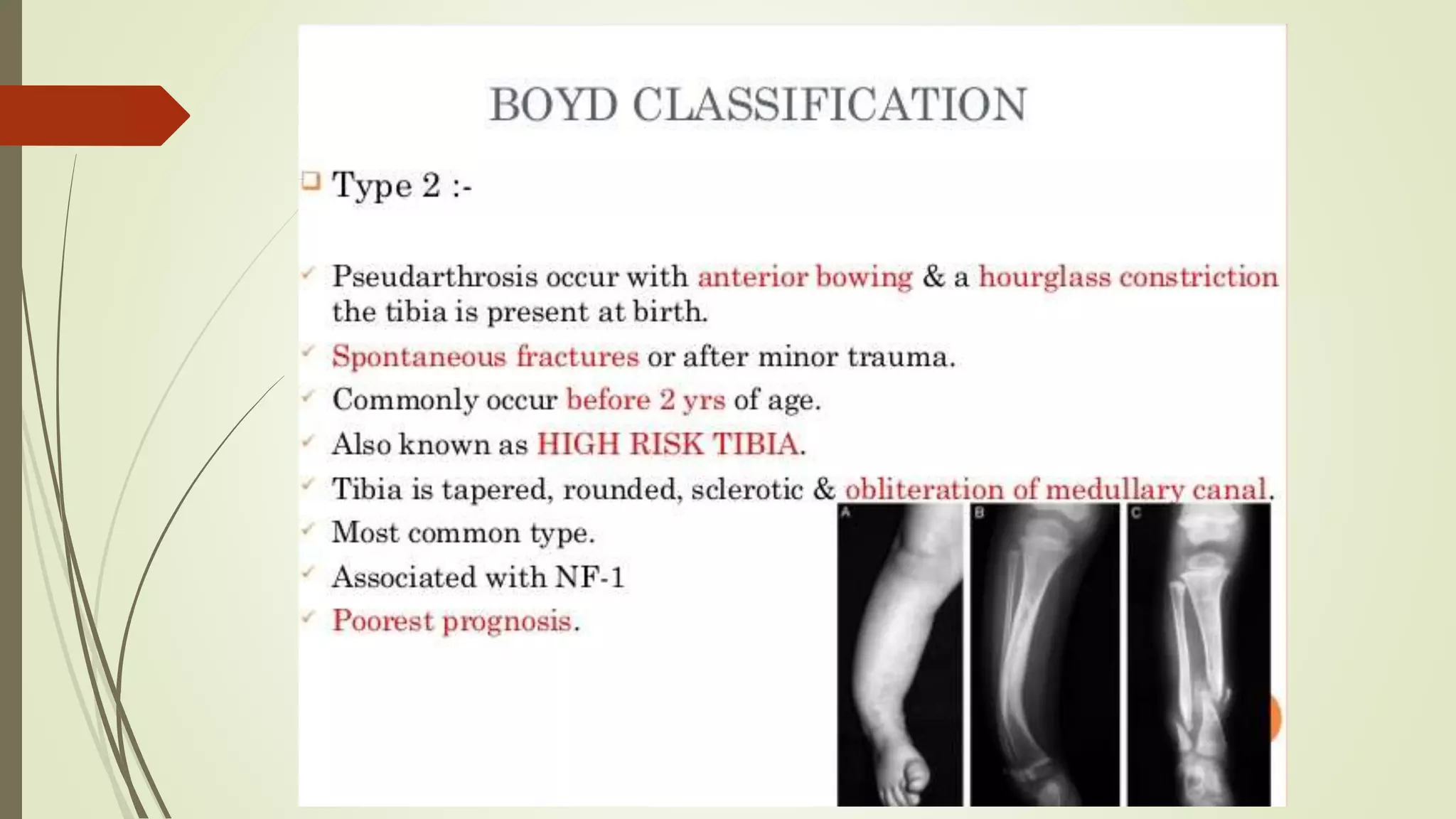 Congenital pseudoarthrosis of tibia | PPTX