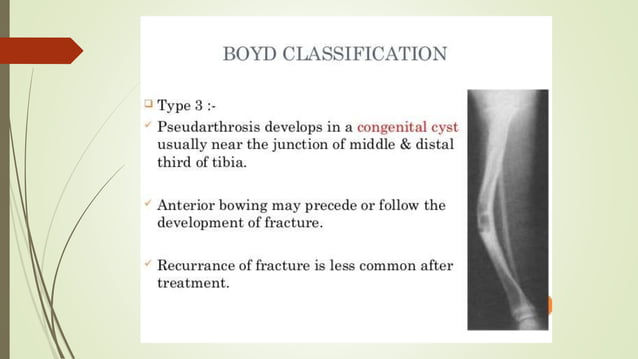 Congenital pseudoarthrosis of tibia | PPTX