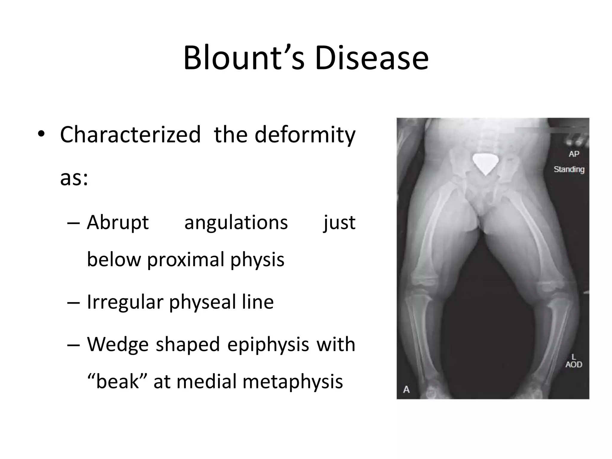 Congenital Pseudoarthrosis of Tibia and Blounte’s Disease.pptx