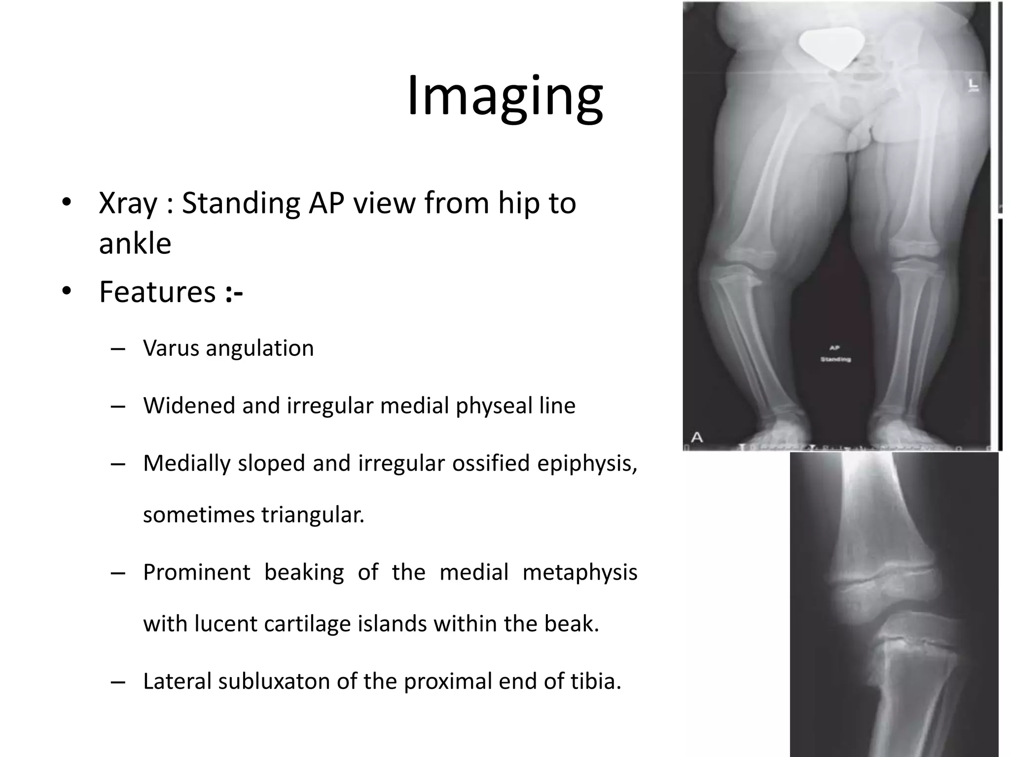 Congenital Pseudoarthrosis of Tibia and Blounte’s Disease.pptx
