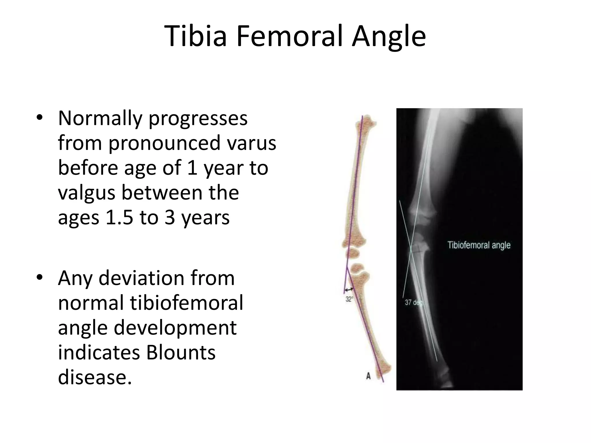 Congenital Pseudoarthrosis of Tibia and Blounte’s Disease.pptx