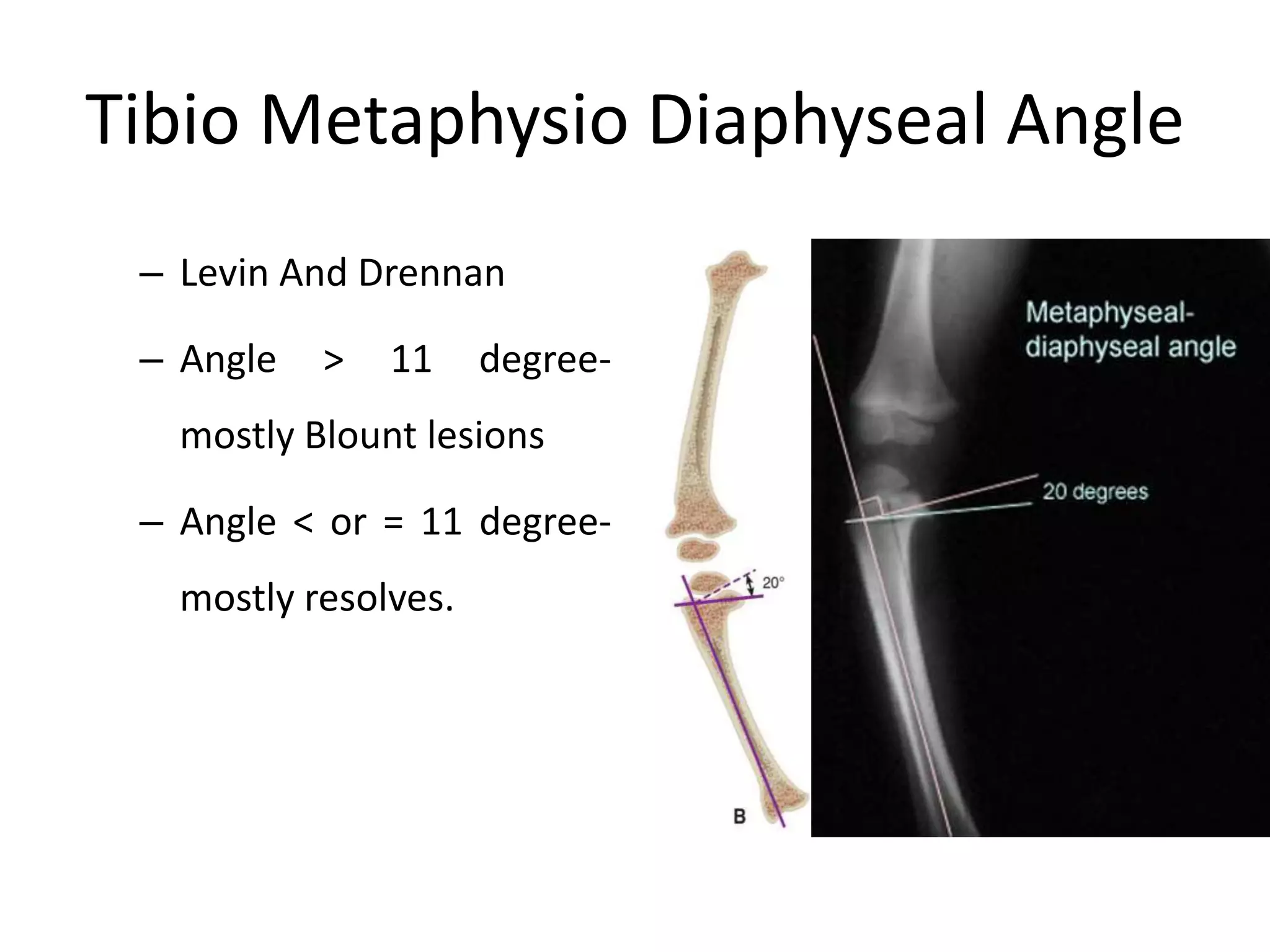 Congenital Pseudoarthrosis of Tibia and Blounte’s Disease.pptx