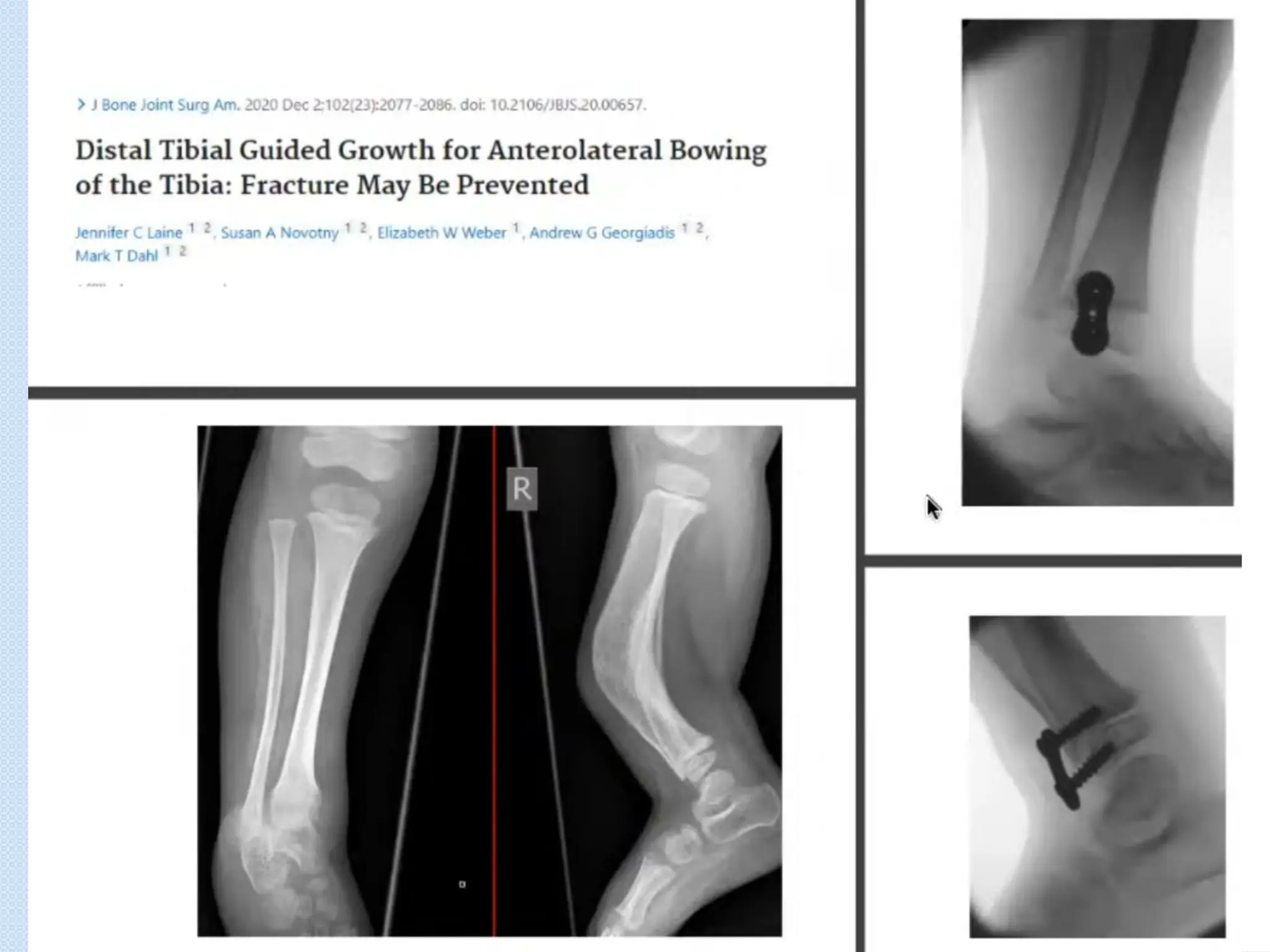 CONGENITAL PSEUDO ARTHROSIS OF TIBIA jainam.pptx