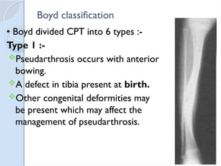CONGENITAL PSEUDO ARTHROSIS OF TIBIA jainam.pptx