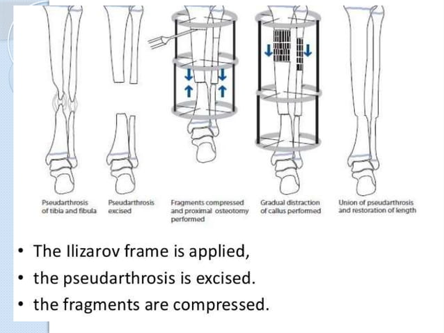 CONGENITAL PSEUDO ARTHROSIS OF TIBIA jainam.pptx
