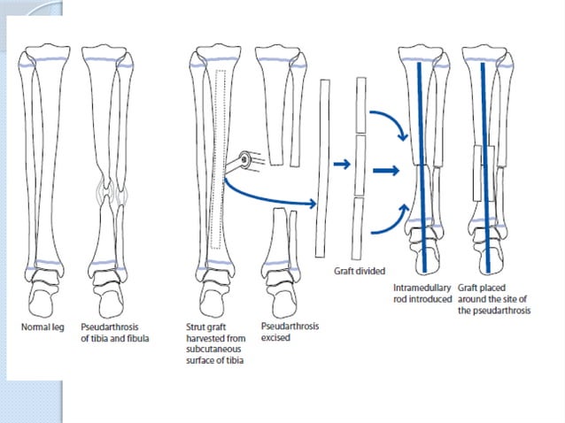 CONGENITAL PSEUDO ARTHROSIS OF TIBIA jainam.pptx
